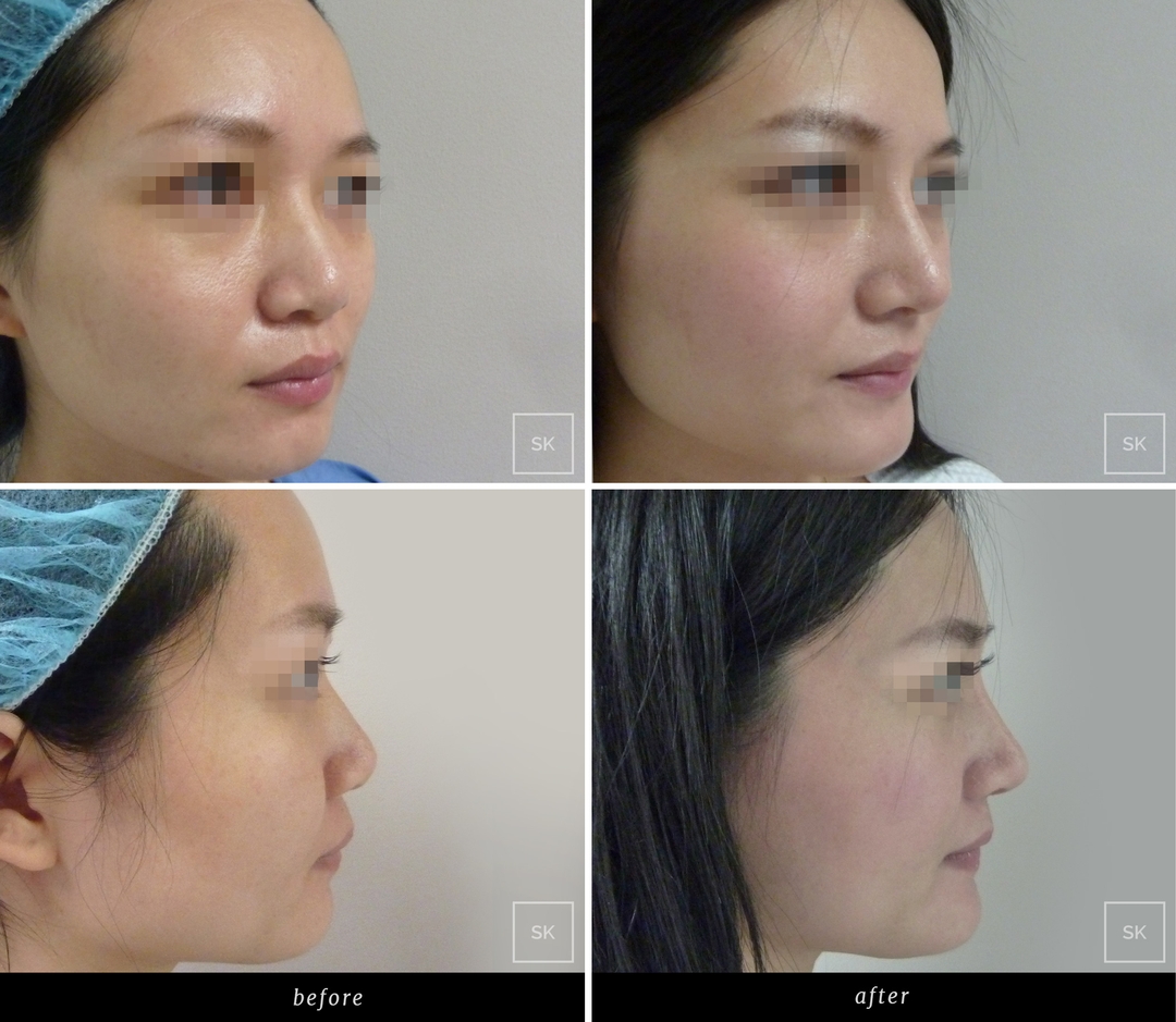 Before and After Nose Surgery Photos - SK Plastic Surgery