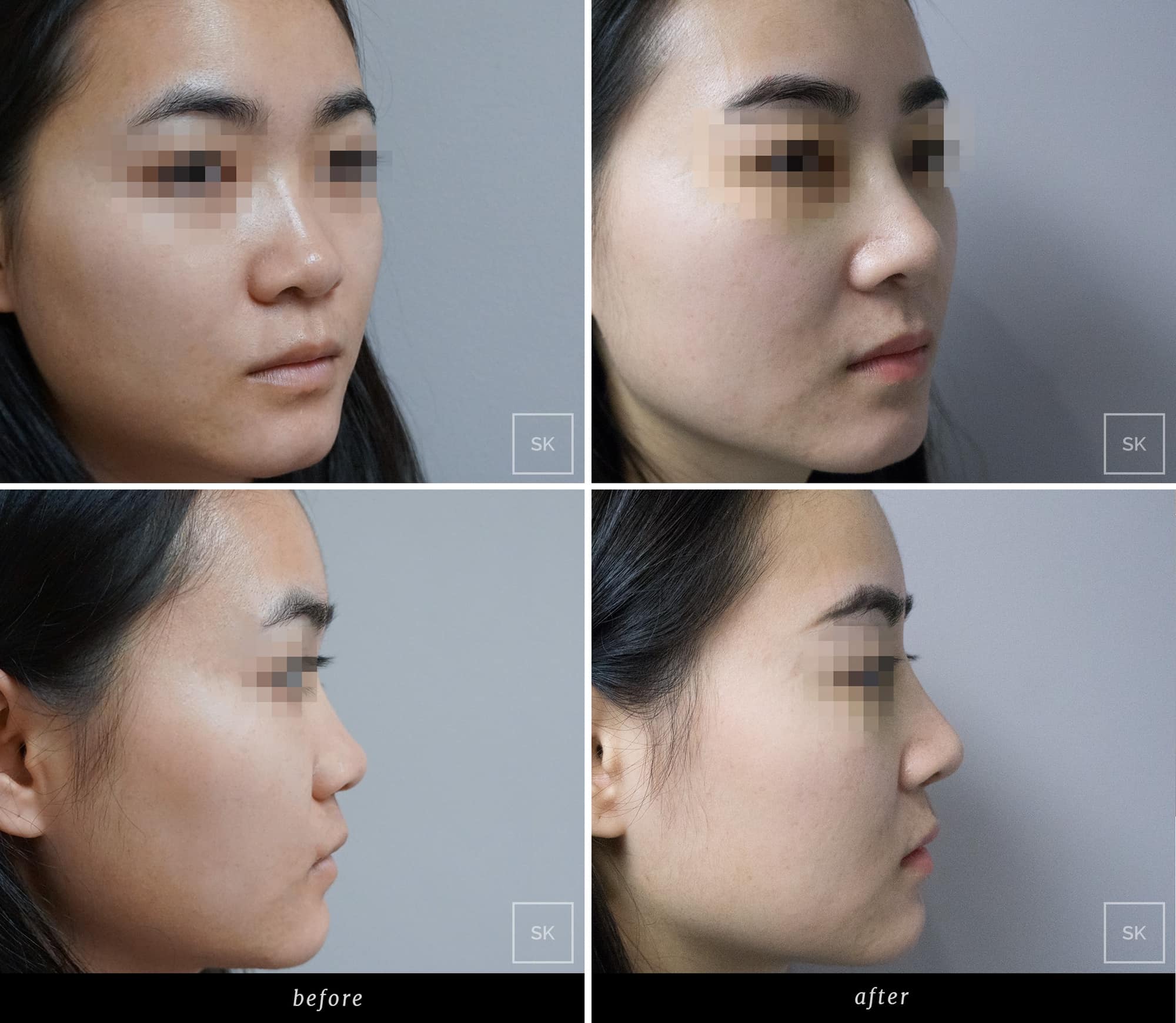 Before and After Nose Surgery Photos - SK Plastic Surgery
