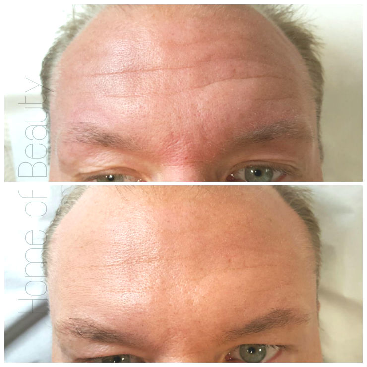 Microneedling - dermapenn - Oslo