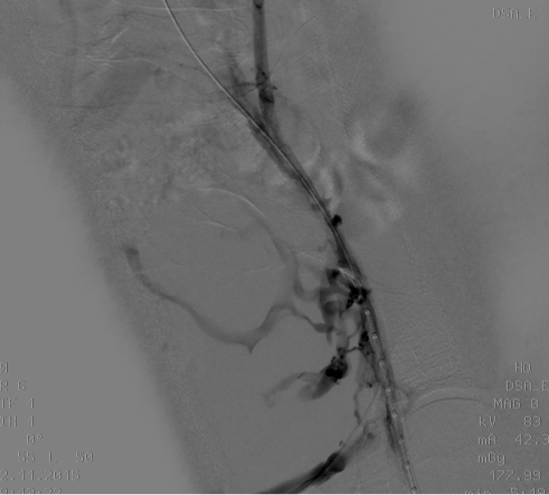 Venous Claudication | Michael Cumming, MD, MBA