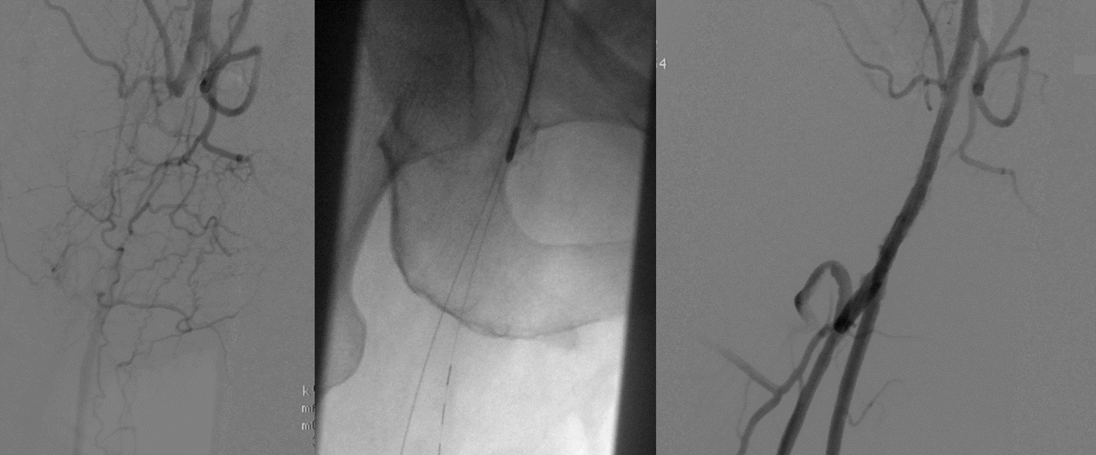 Claudication and rest pain secondary to CFA occlusion | Michael Cumming ...