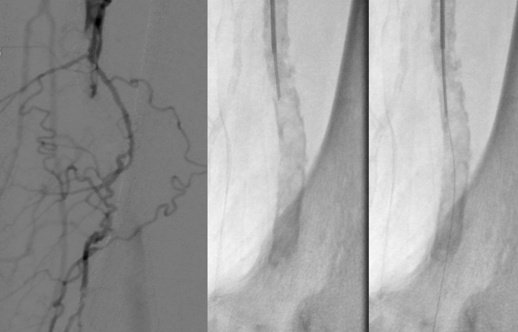 Chiba Needle Sharp Recanalization for CLI | Michael Cumming, MD, MBA