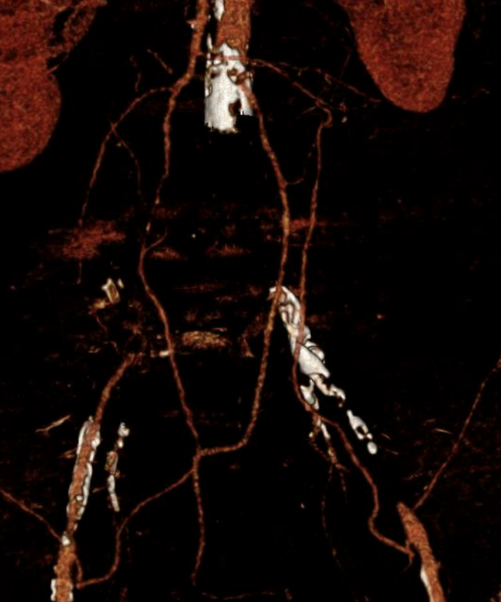 CERAB Technique for AortoIliac Reconstruction | Michael Cumming, MD, MBA