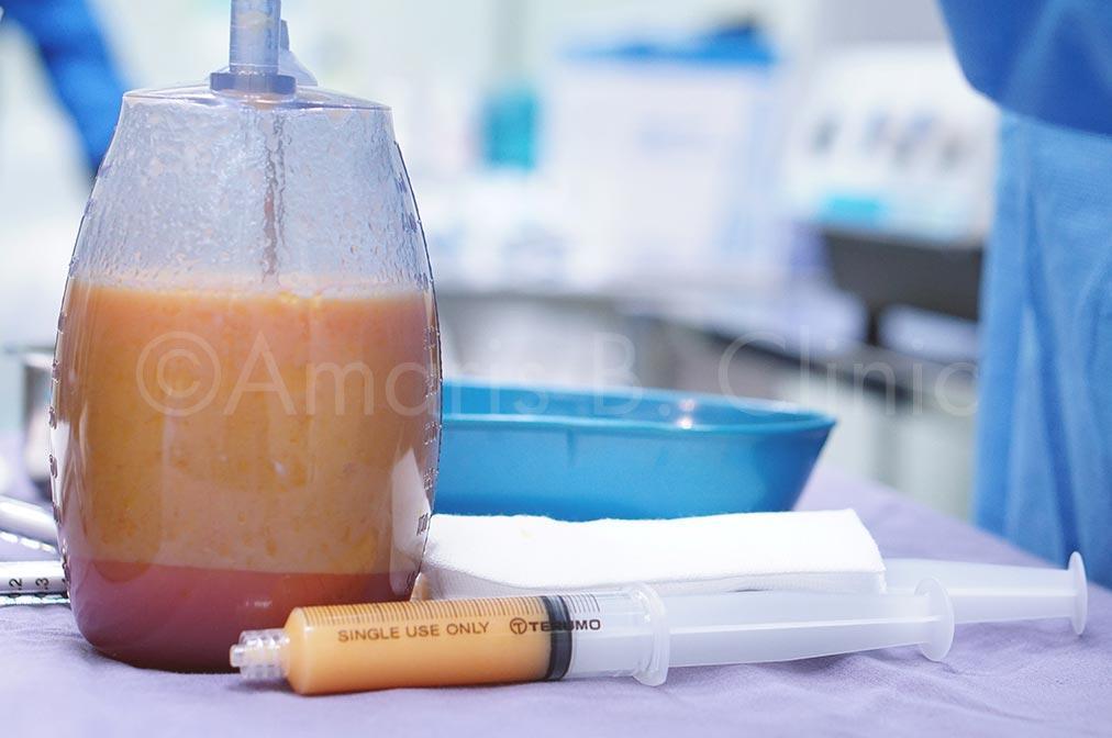 Implants or fat grafting for breast augmentation?