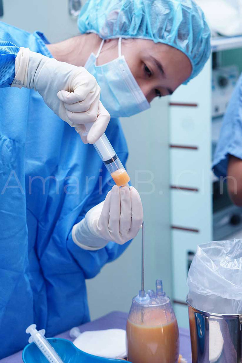 Fat Grafting 101: More Than Just A Breast Enhancement Treatment