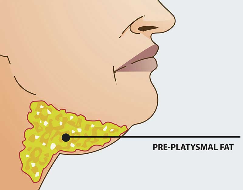 What To Expect From A Double Chin Liposuction in Singapore