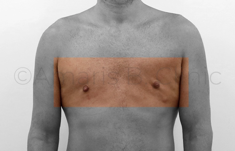 Mid-40s Caucasian Man, Botched Gynecomastia Surgery