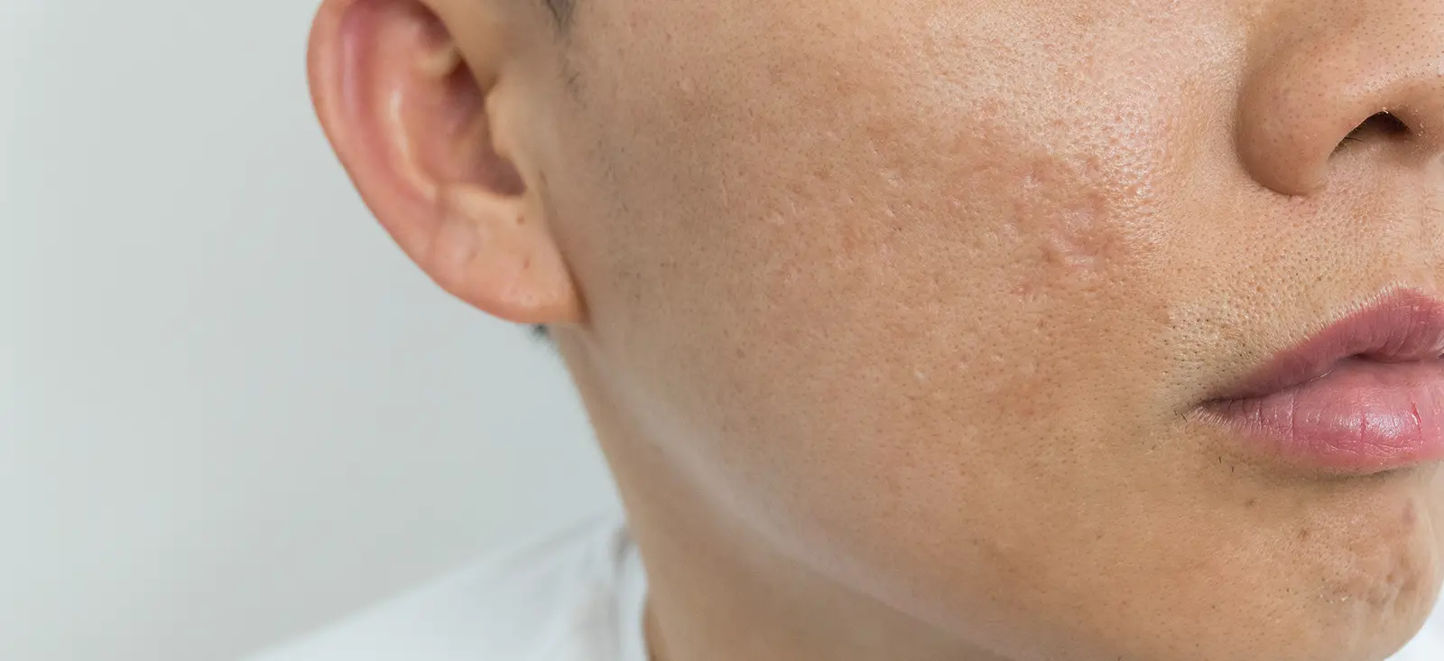 Acne, large pores & pigmentation with pico fractional laser