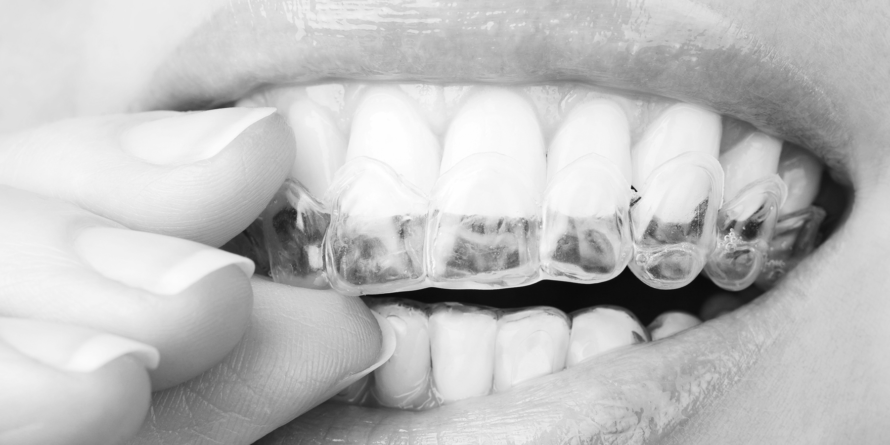 How Invisalign® Creates Beautifully Straight Smiles | Dayton Dental ...