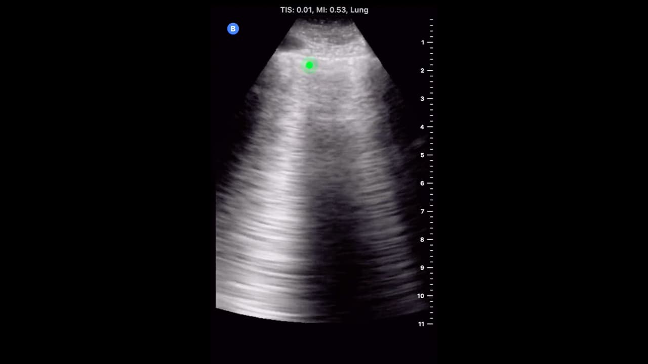 Point of care ultrasound at the bedside in E Med | Butterfly iQ3
