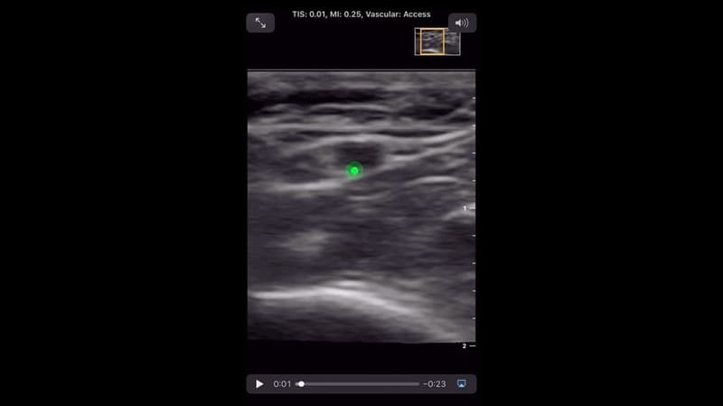 Point of care ultrasound at the bedside for Anesthesiology | Butterfly iQ3