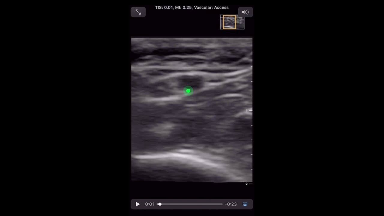Point of care ultrasound at the bedside for Anesthesiology | Butterfly iQ3