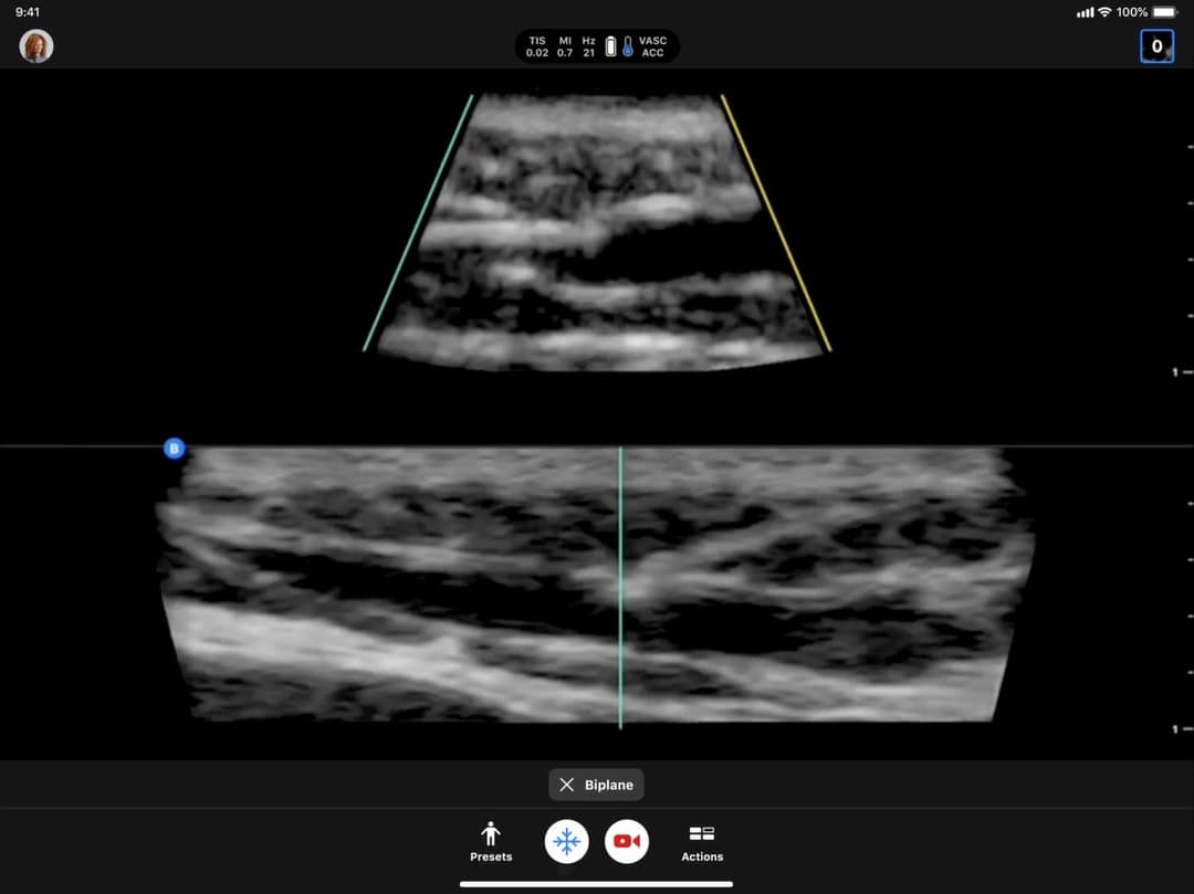 Point of care ultrasound at the bedside in E Med | Butterfly iQ3