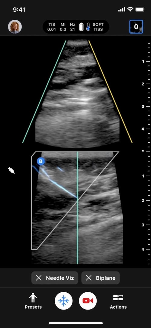 Point of care ultrasound at the bedside for Anesthesiology | Butterfly iQ3