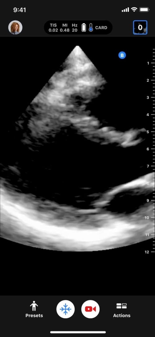 Point of care ultrasound at the bedside for Anesthesiology | Butterfly iQ3