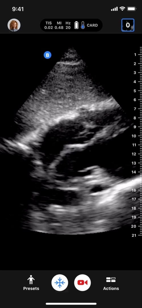 Point of care ultrasound at the bedside in E Med | Butterfly iQ3