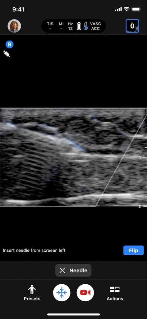 Point of care ultrasound at the bedside in E Med | Butterfly iQ3