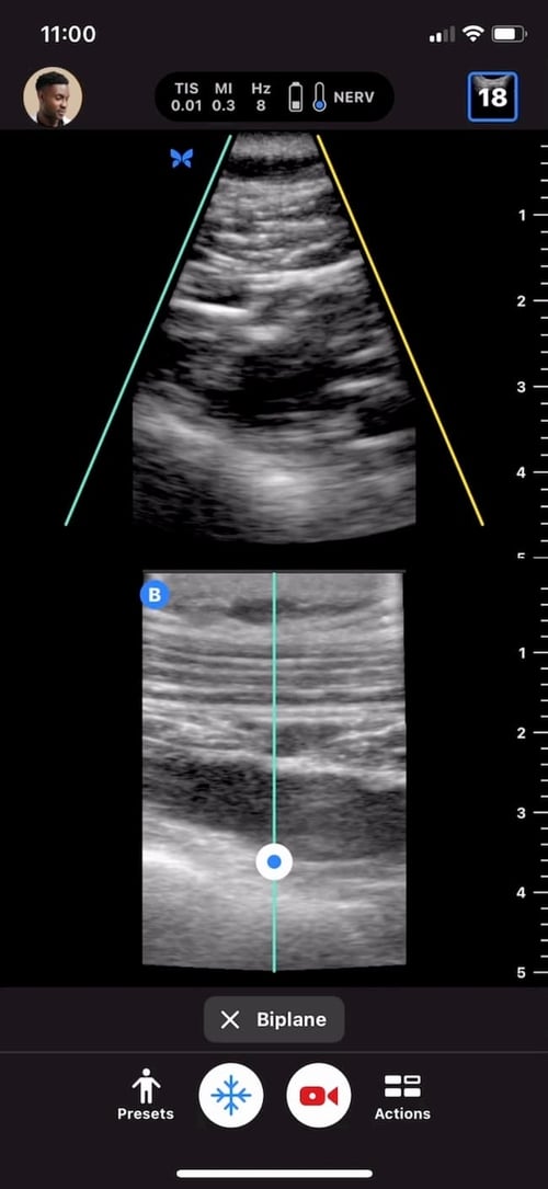 Point of care ultrasound at the bedside in ICU | Butterfly iQ3