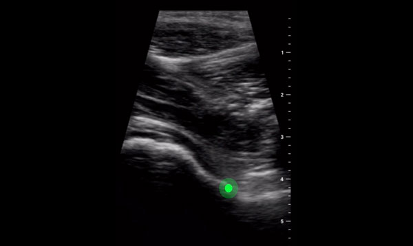 Point of care ultrasound at the bedside for MSK | Butterfly iQ3