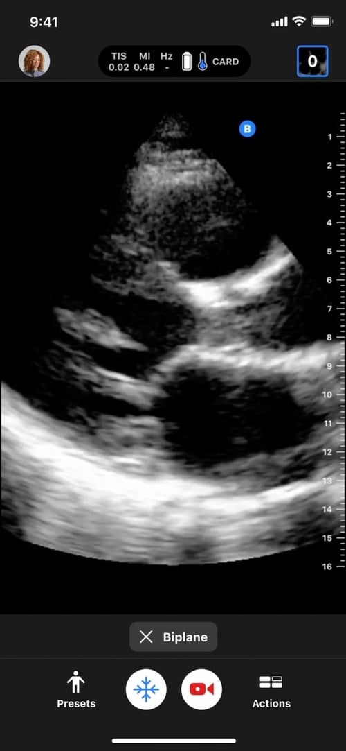 Point-of-care ultrasound at the bedside in Cardiology | Butterfly iQ+