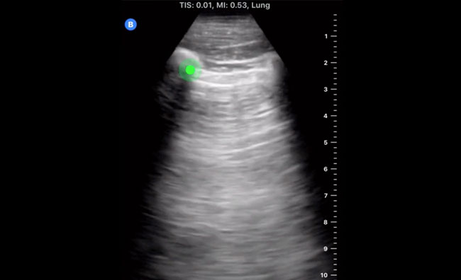 Point of care ultrasound at the bedside for Hospitalists | Butterfly iQ3