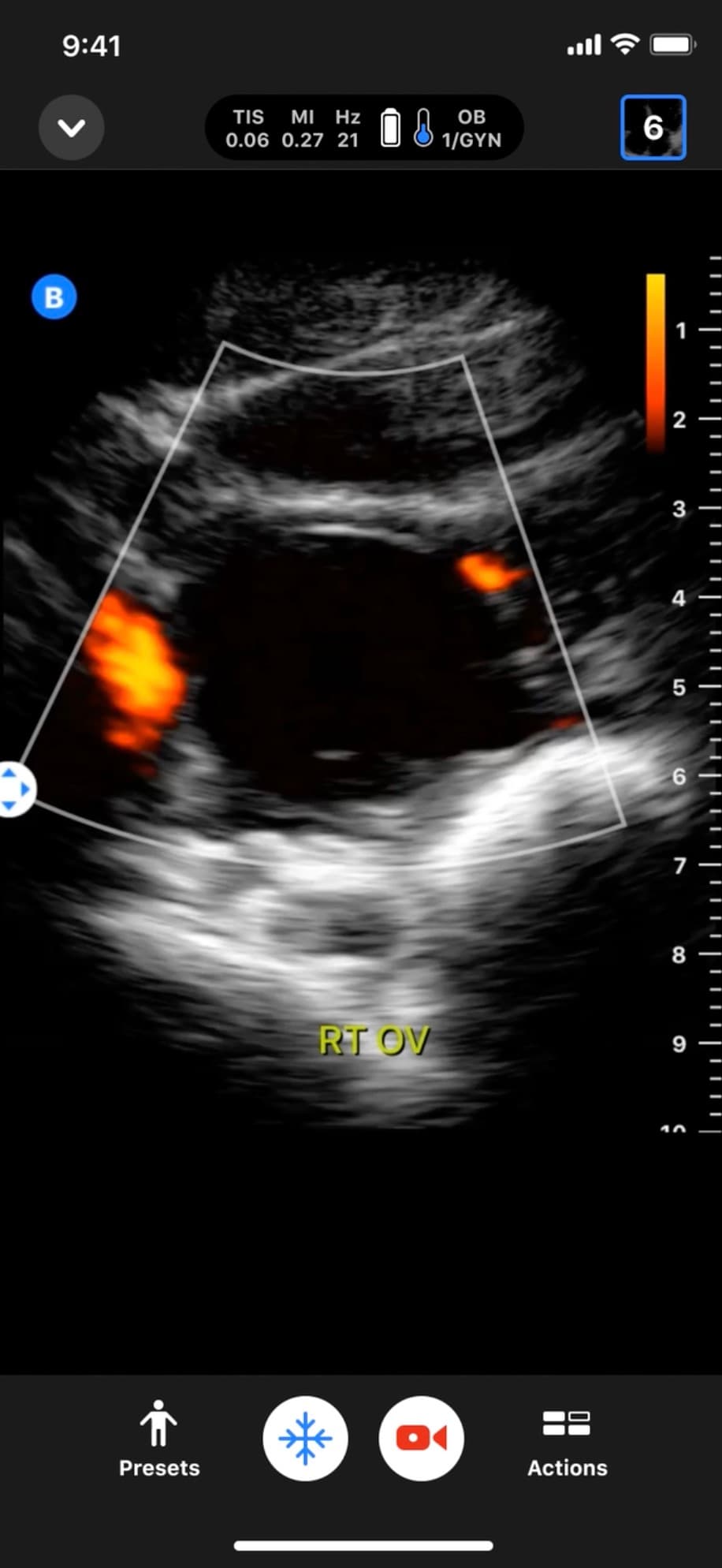 Portable ultrasound for OB/GYN and Labor & Delivery | Butterfly iQ3