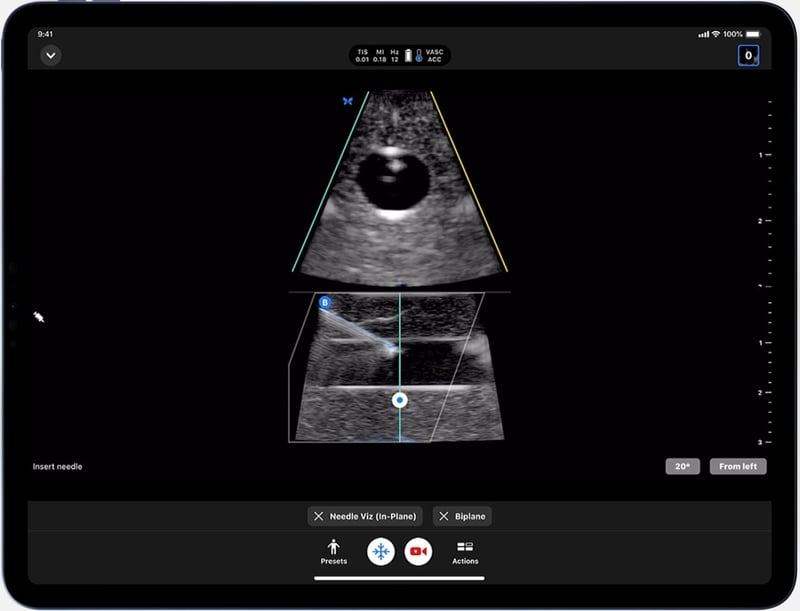 Point of care ultrasound at the bedside for Nurses | Butterfly iQ3
