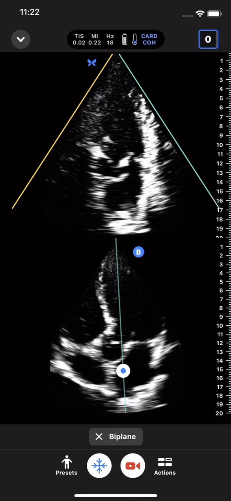 Point of care ultrasound at the bedside in Cardiology | Butterfly iQ3