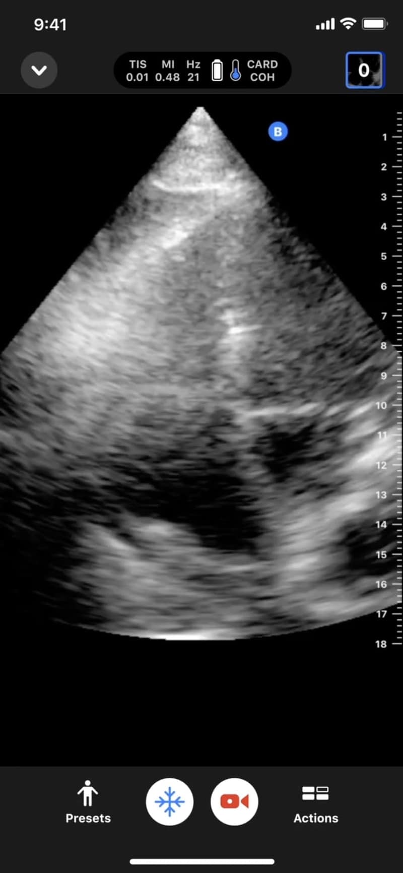 Point of care ultrasound at the bedside in Cardiology | Butterfly iQ3