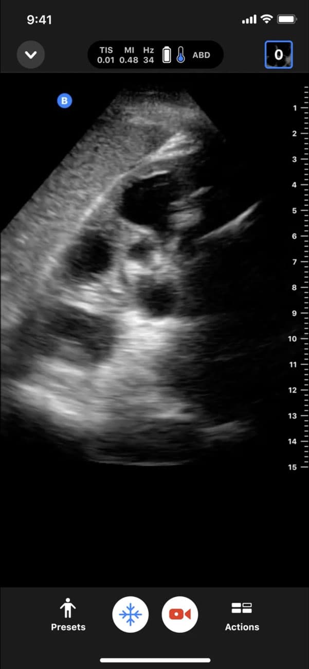 Portable ultrasound for Urology | Butterfly iQ3