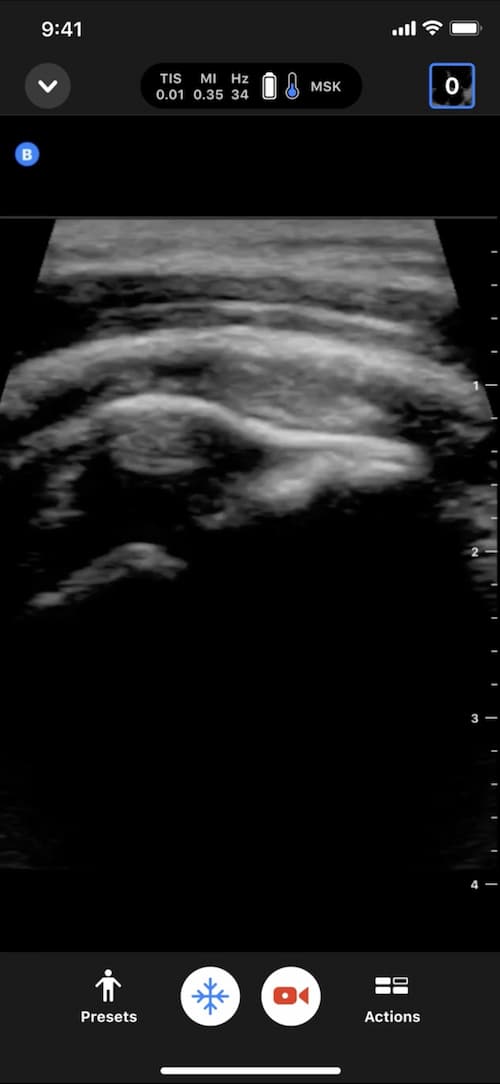 Point of care ultrasound at the bedside for MSK | Butterfly iQ3