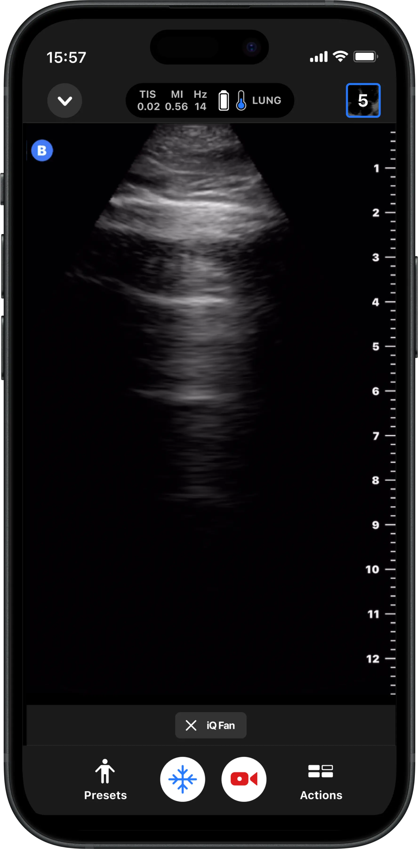 iQ3 Ultrasound | The clear answer in point-of-care ultrasound.