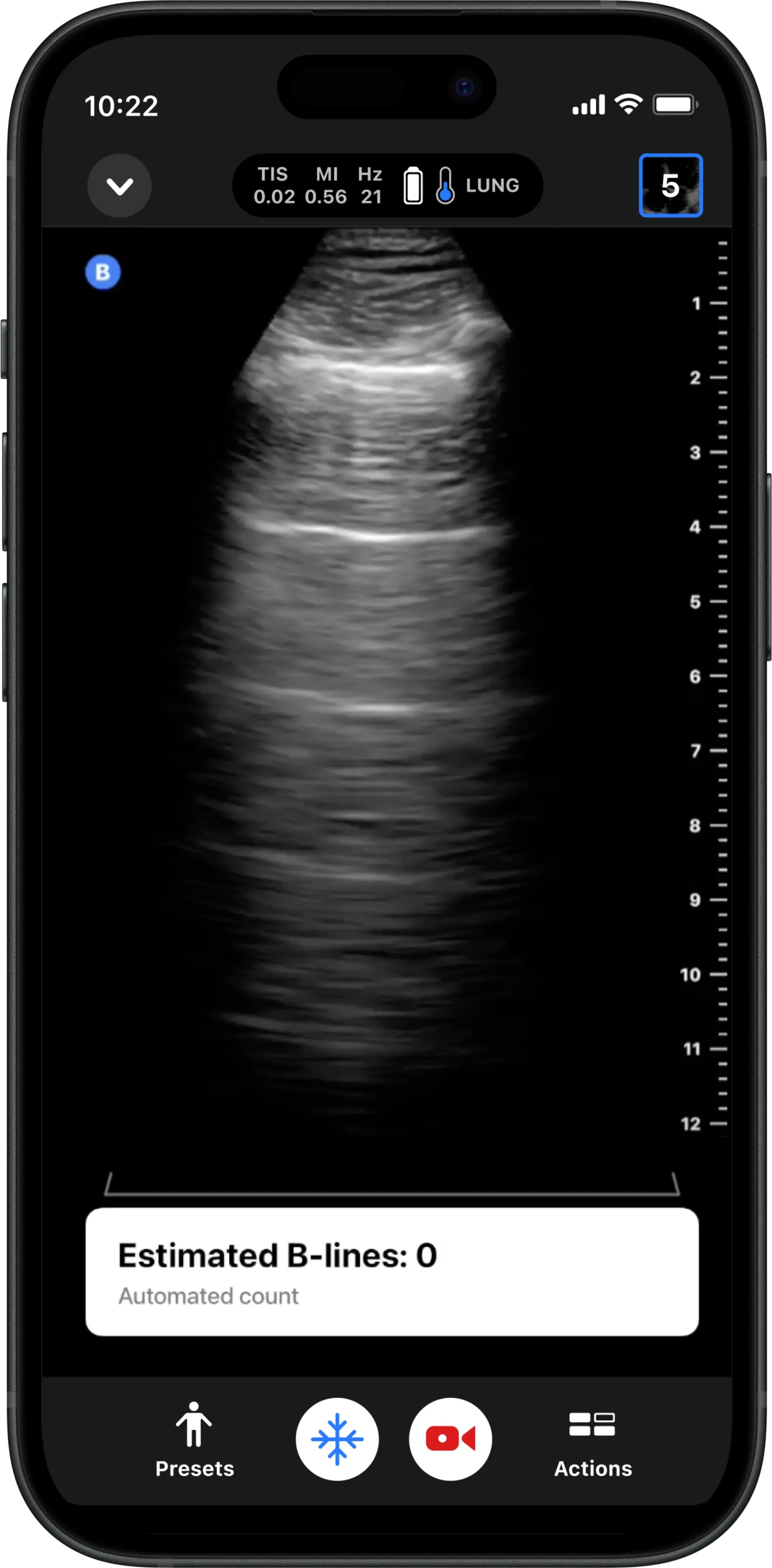 iQ3 Ultrasound | The clear answer in point-of-care ultrasound.