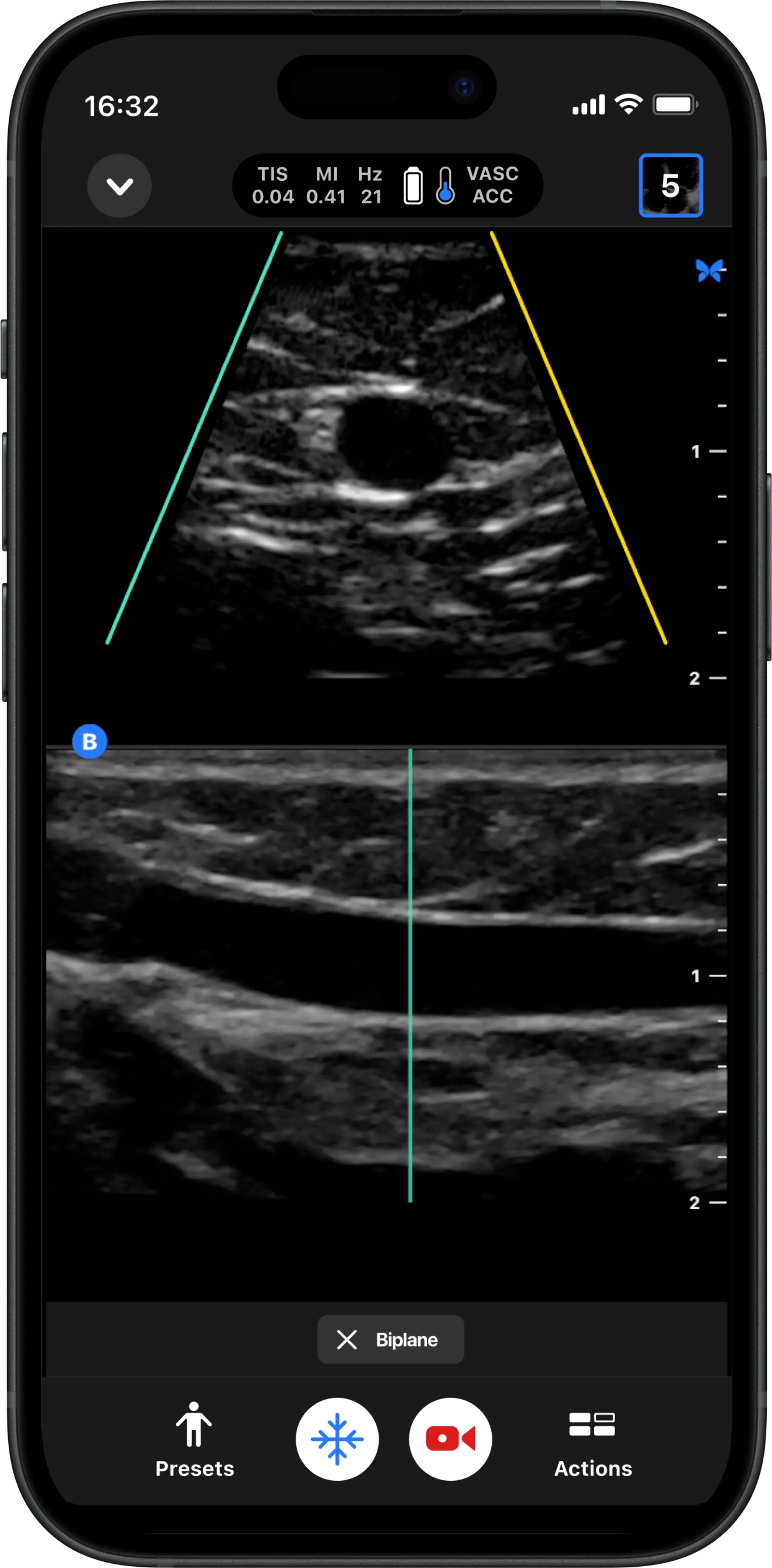 iQ3 Ultrasound | The clear answer in point-of-care ultrasound.