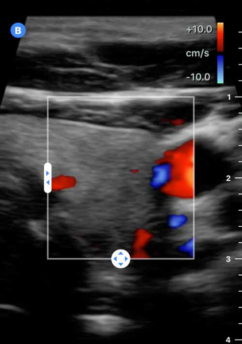 Small Organ - Clinical Gallery - Butterfly iQ