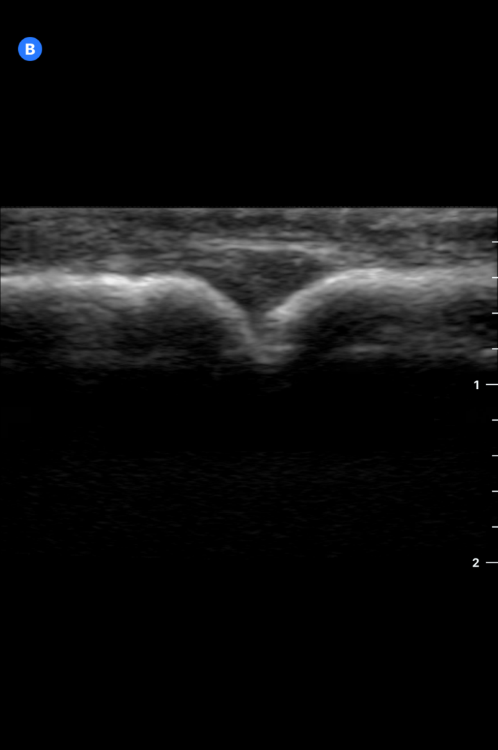 MSK POCUS images | Butterfly iQ