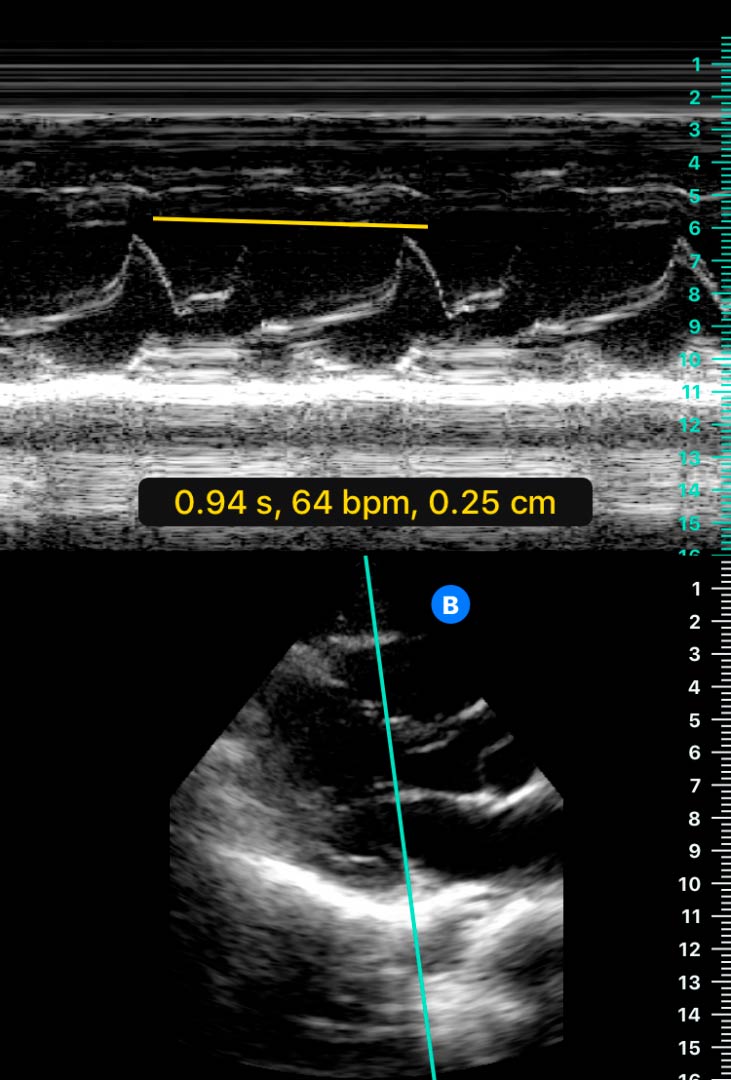 Cardiac POCUS images | Butterfly iQ