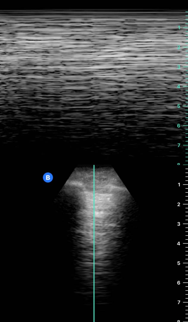 Lung - Clinical Gallery - Butterfly iQ