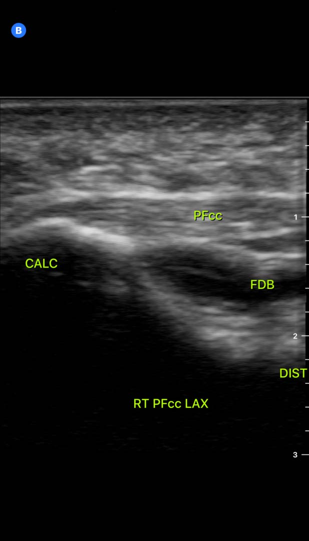 MSK POCUS images | Butterfly iQ