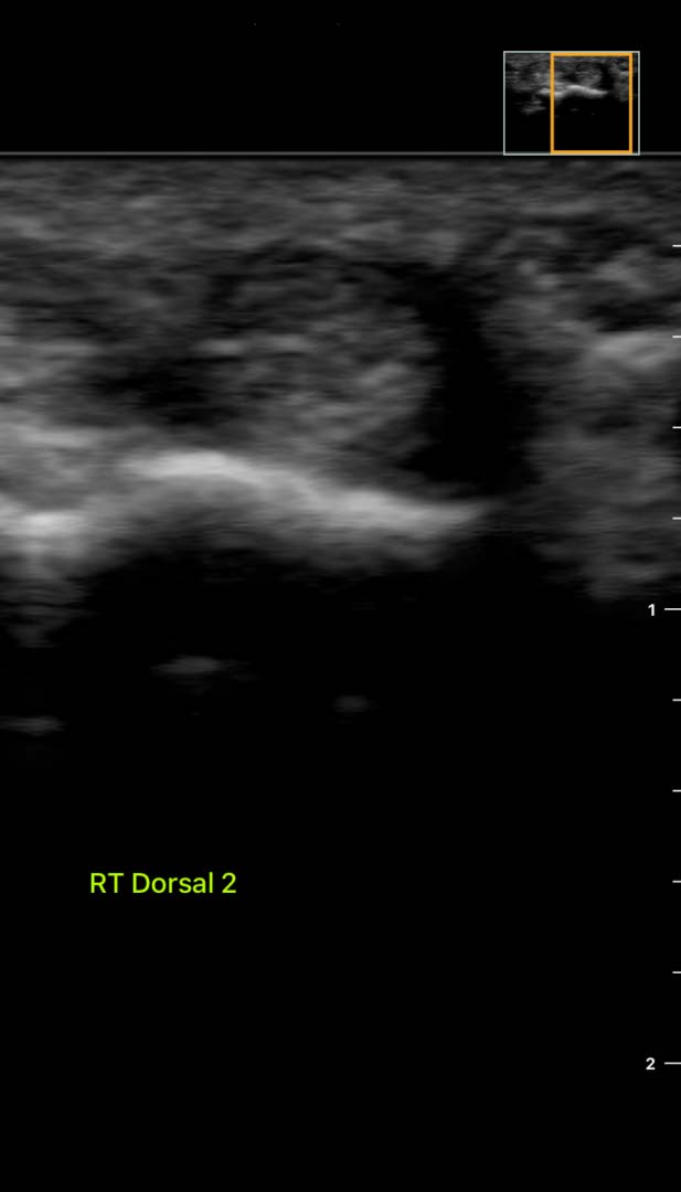 MSK POCUS images | Butterfly iQ