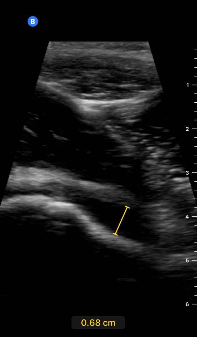 MSK POCUS images | Butterfly iQ