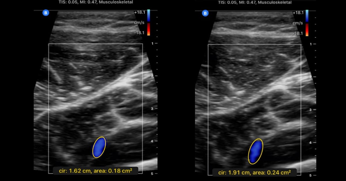 Case Studies - The Use of the Butterfly iQ to Measure Blood Flow After ...