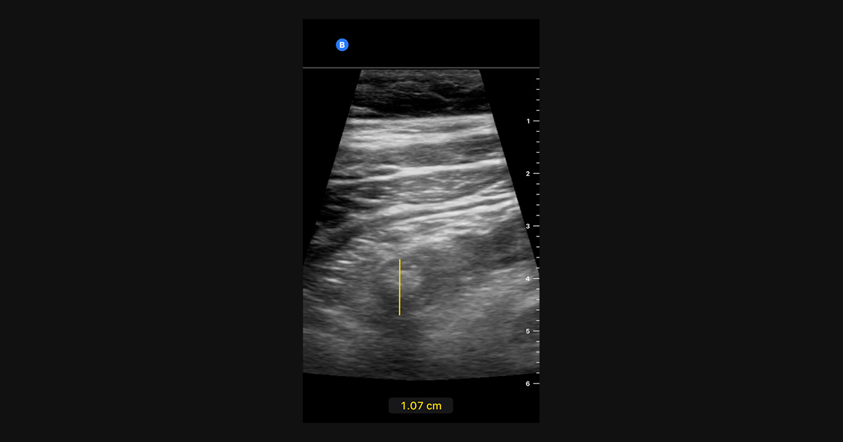 Pediatric cardiac POCUS images | Butterfly iQ