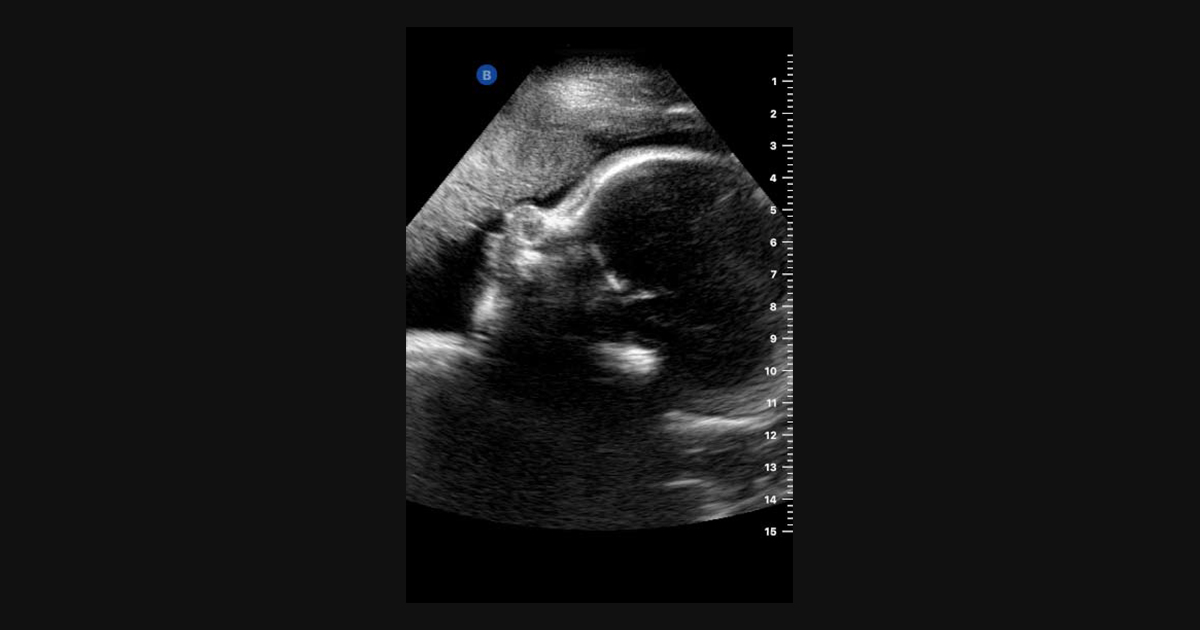 OB/GYN POCUS images | Butterfly iQ