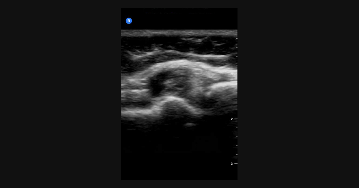 MSK POCUS images | Butterfly iQ