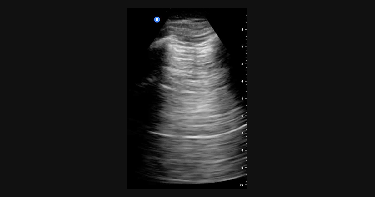 Lung POCUS images | Butterfly iQ