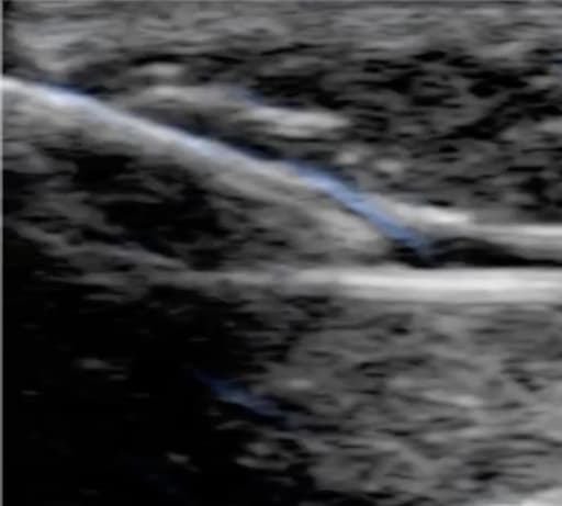 Case Studies - Point-of-care ultrasound (POCUS) for the early detection ...