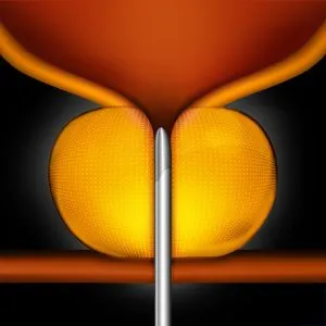 Minimally-Invasive Treatment for BPH: UroLift®