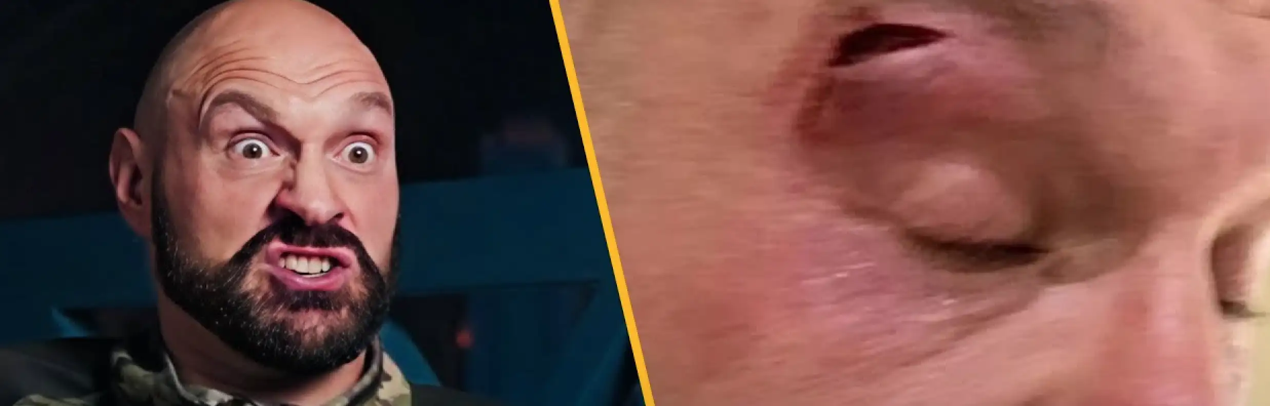 Tyson Fury's cut could reopen in his showdown with Oleksandr Usyk