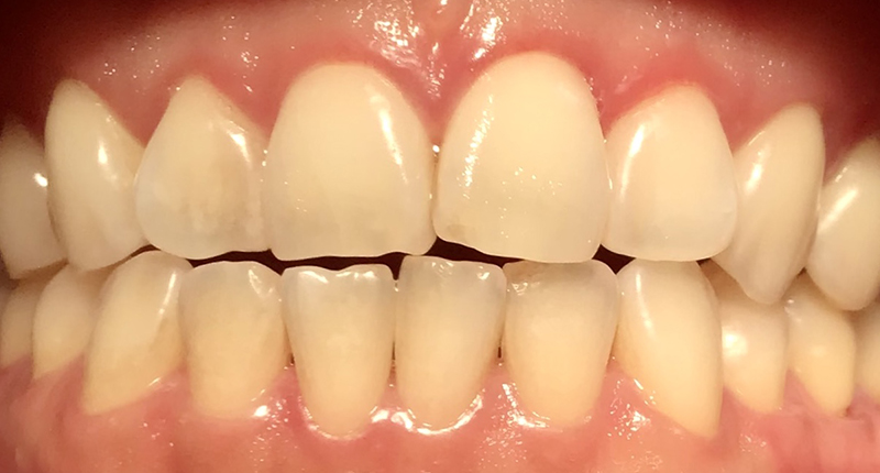 Invisalign in Seattle | Green Leaf Dental